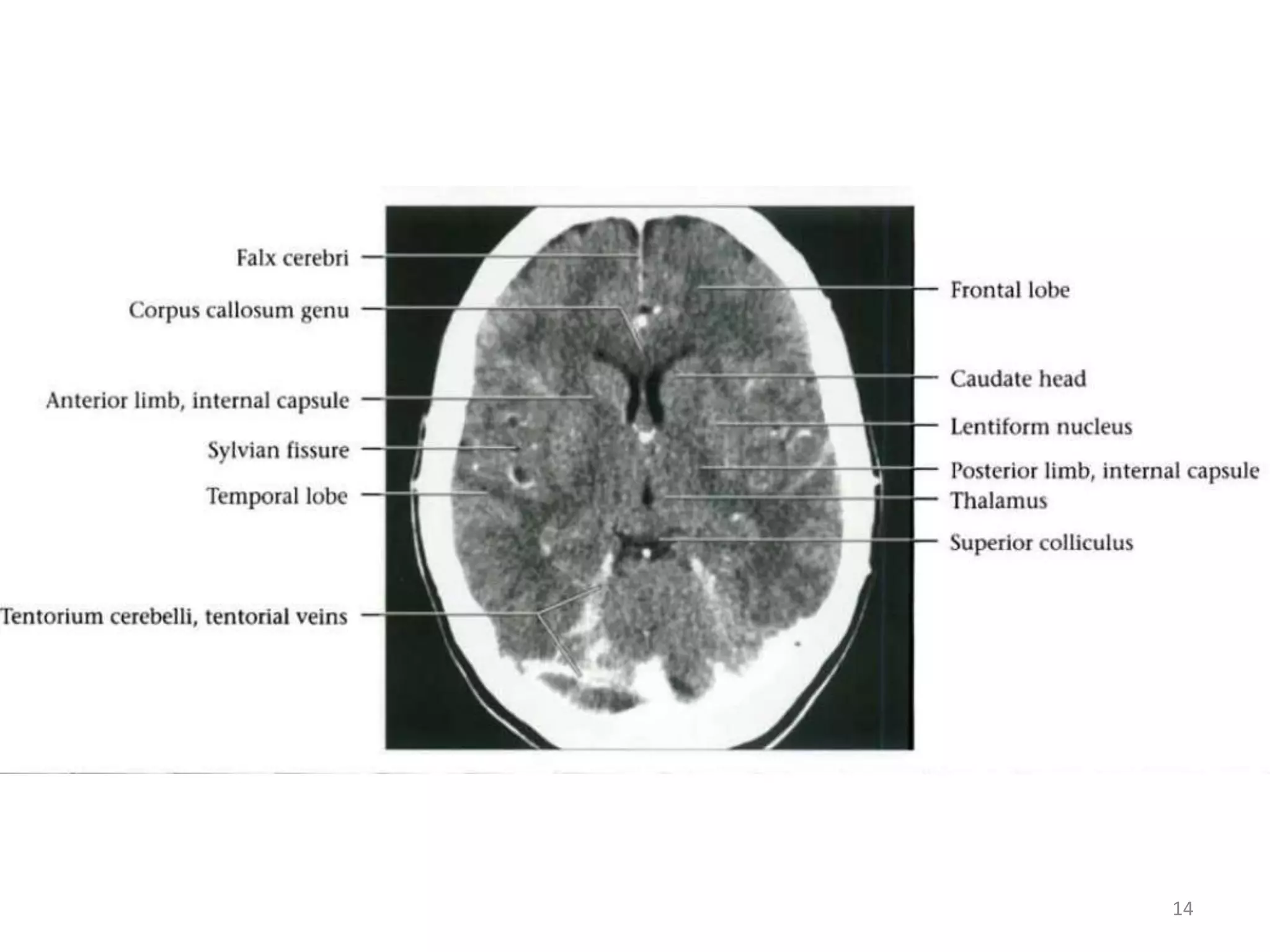 Normal Anatomy Of The Brain On Ct And Mri With A Few Normal Variants