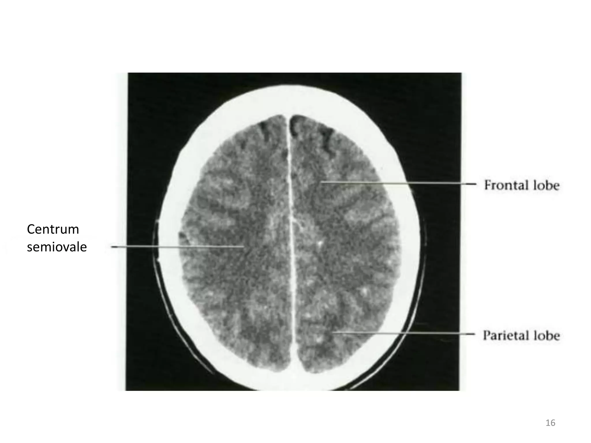 Normal anatomy of brain on CT and MRI | PPTX