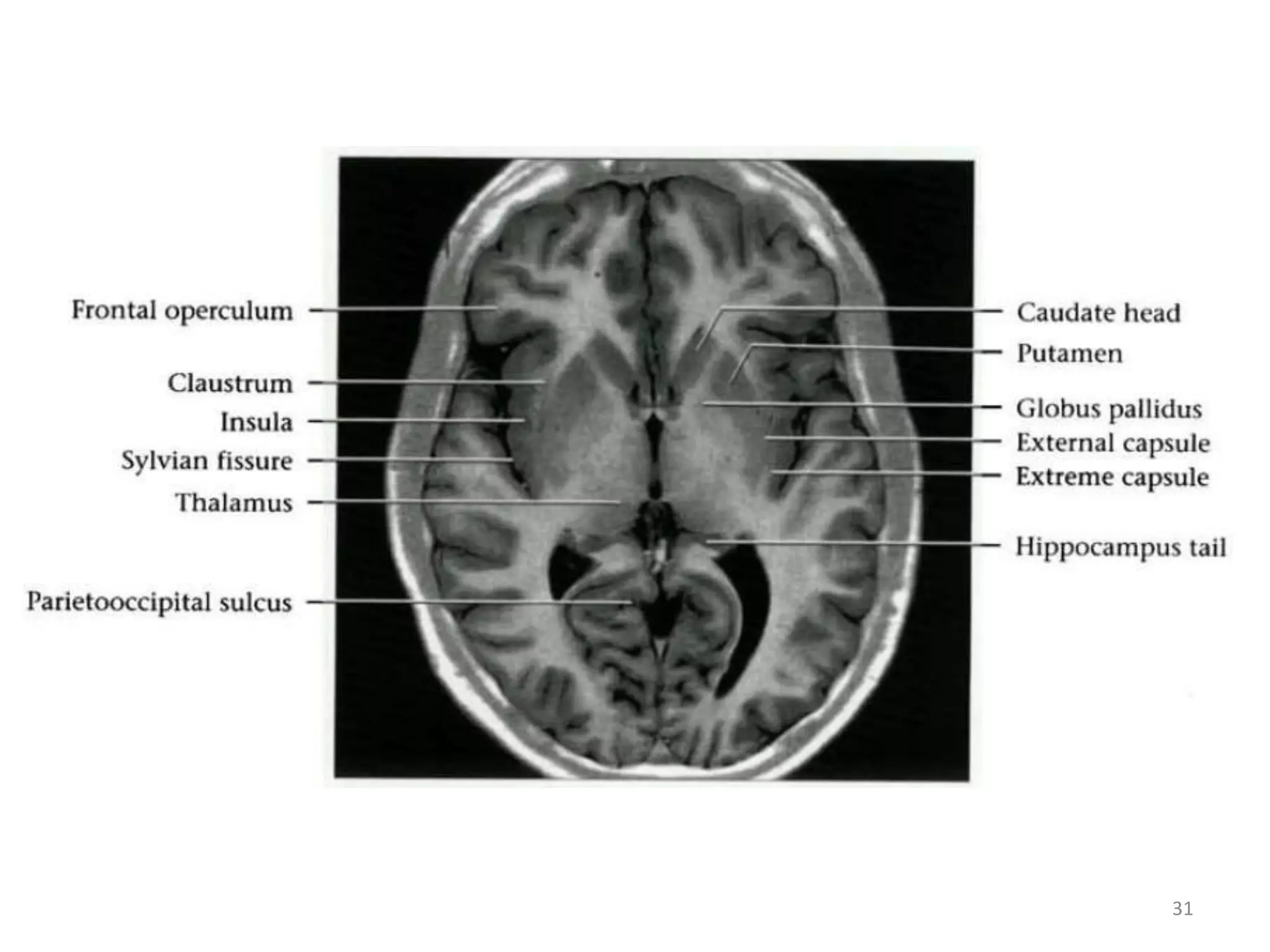 Normal anatomy of brain on CT and MRI | PPTX