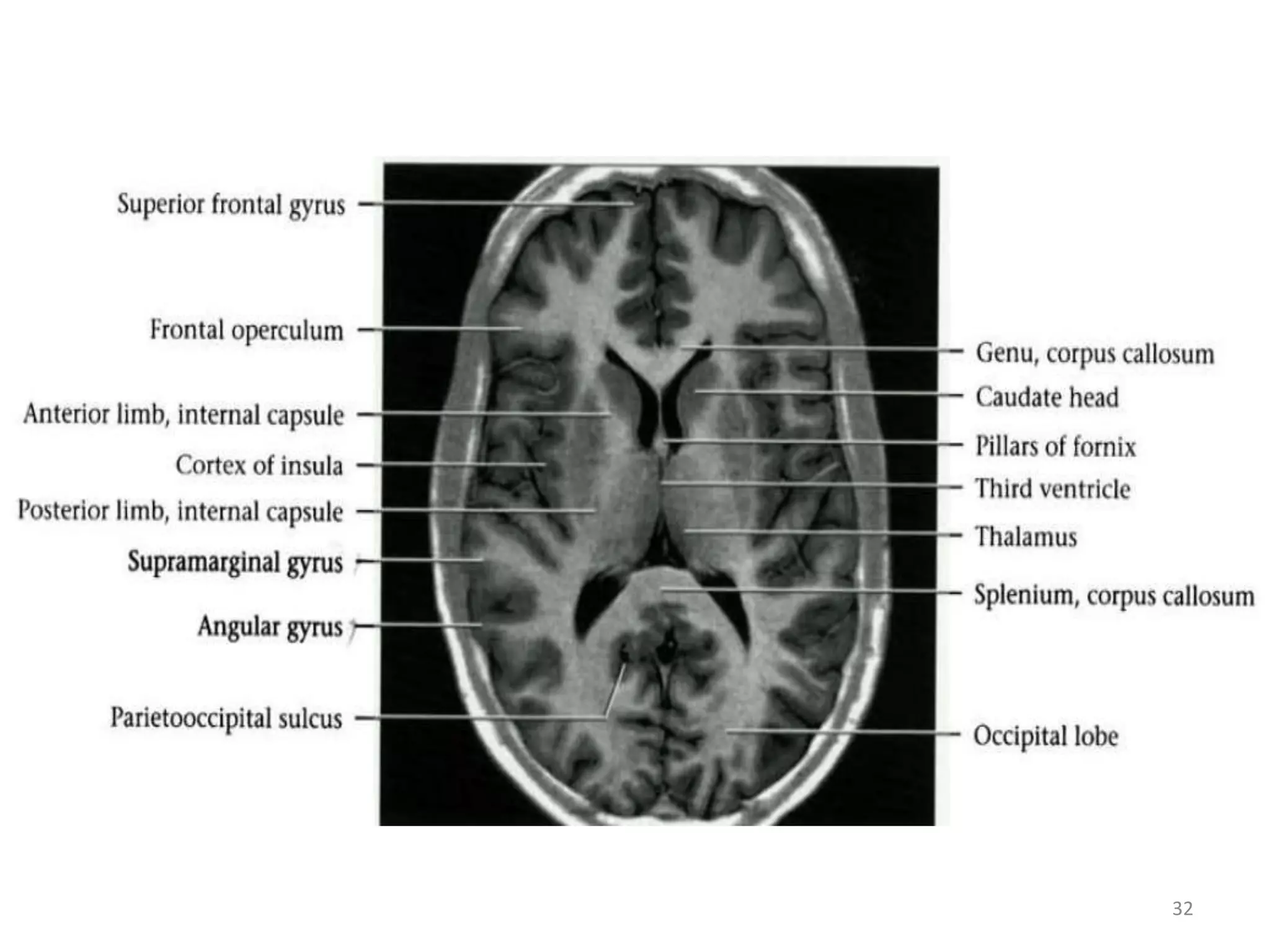 Normal anatomy of brain on CT and MRI | PPTX