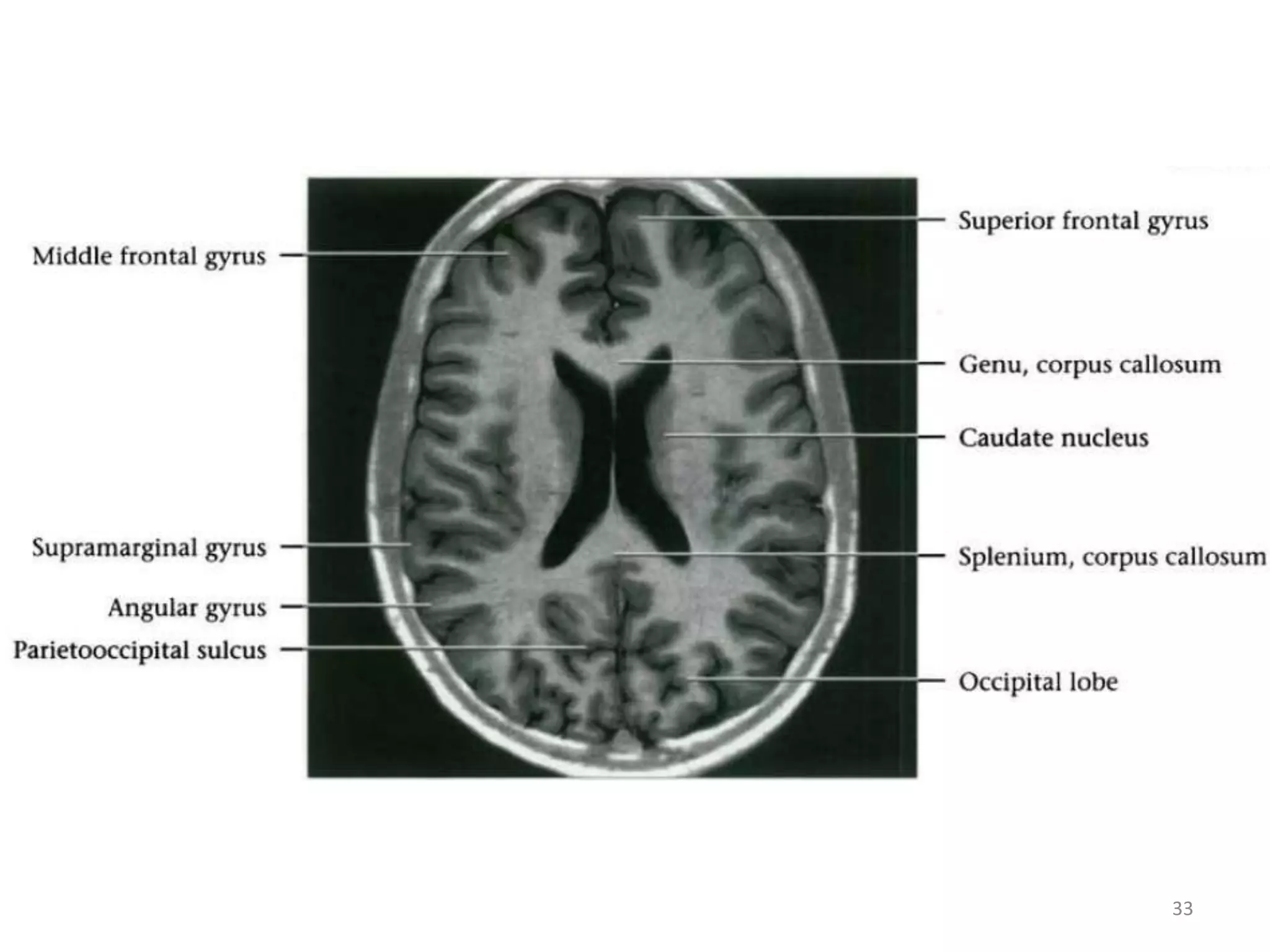 Normal anatomy of brain on CT and MRI | PPTX