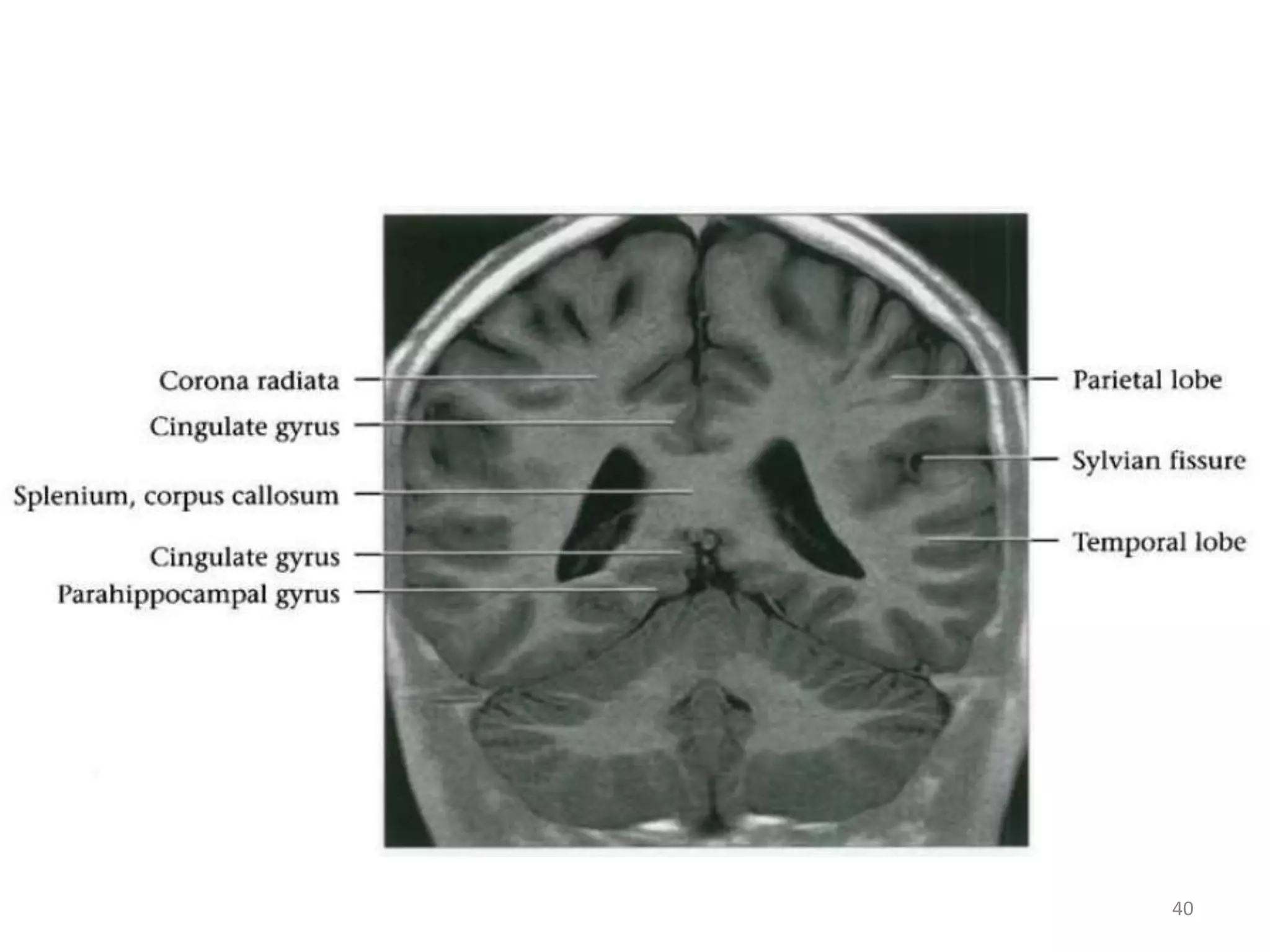 Normal anatomy of brain on CT and MRI | PPTX