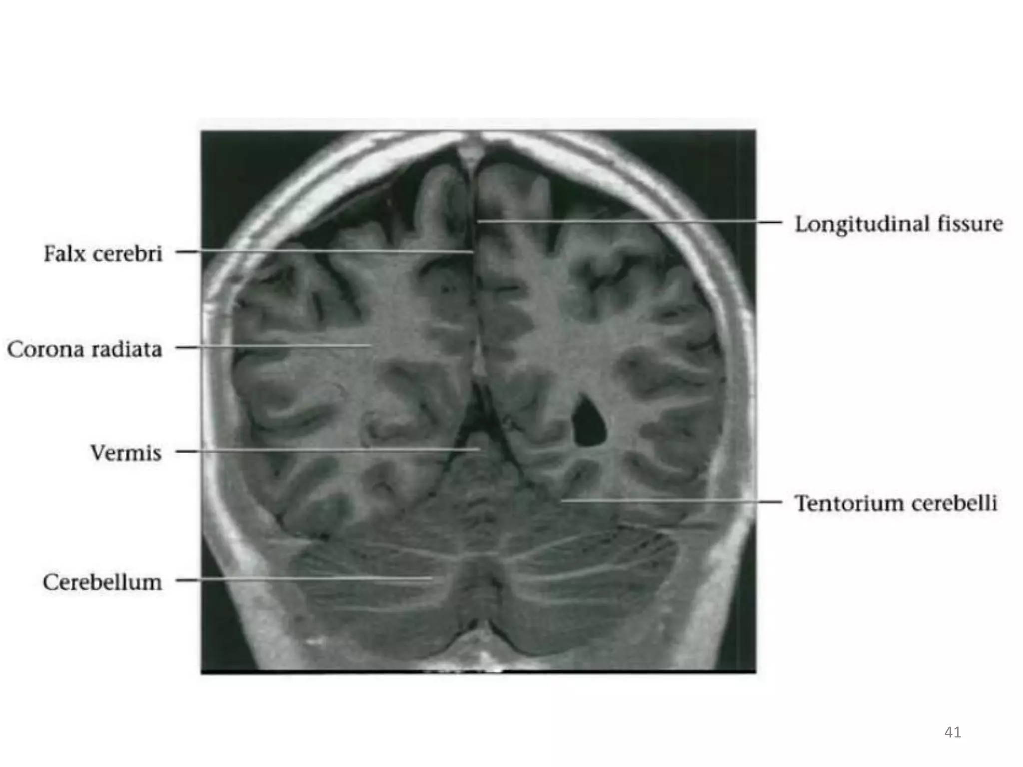 Normal anatomy of brain on CT and MRI | PPTX