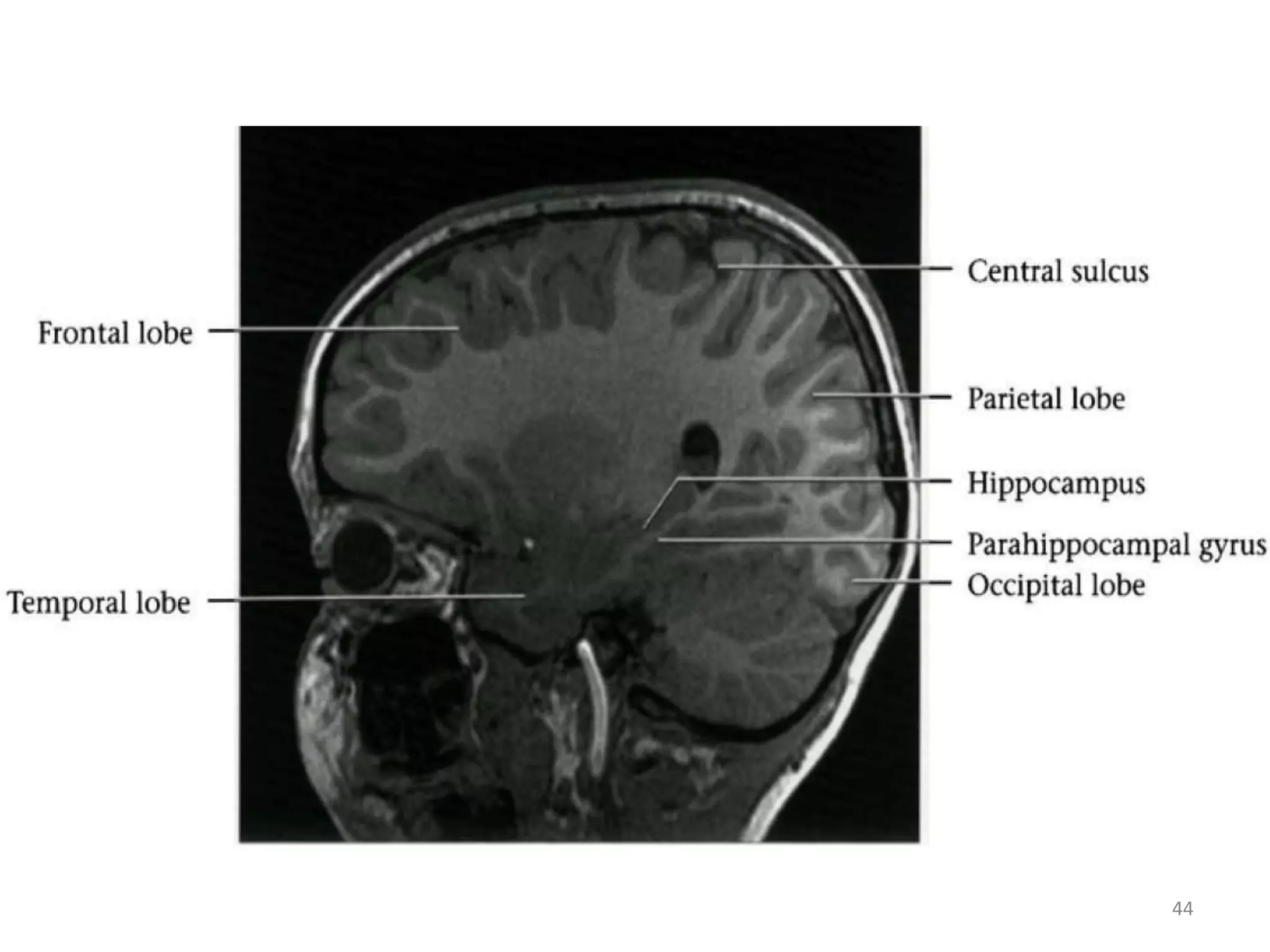 Normal anatomy of brain on CT and MRI | PPTX