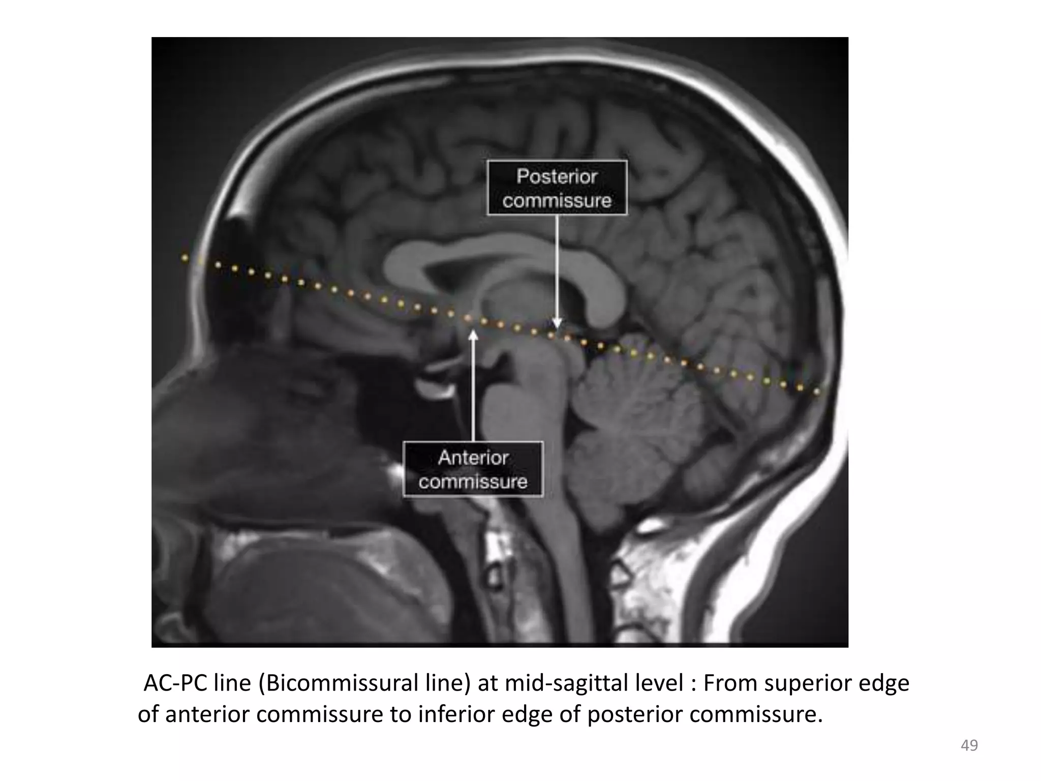 Normal anatomy of brain on CT and MRI | PPTX