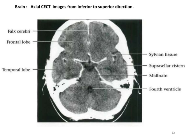 Normal anatomy of brain on CT and MRI | PPTX | Pregnancy | Reproductive ...