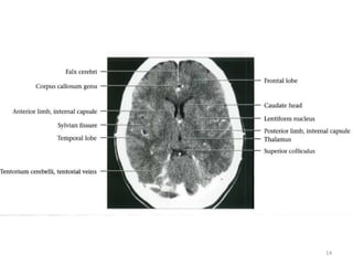 Normal anatomy of brain on CT and MRI | PPTX