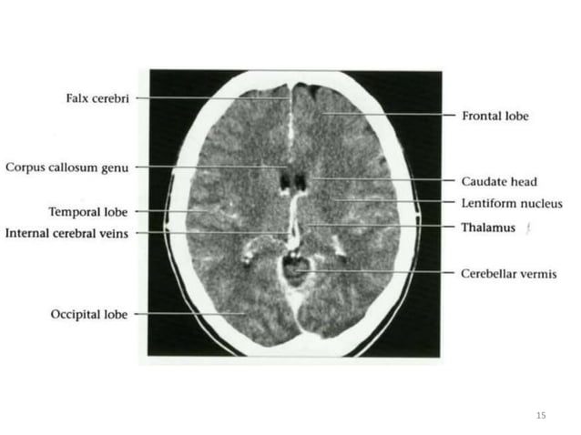Normal anatomy of brain on CT and MRI | PPTX | Pregnancy | Reproductive ...