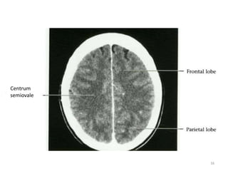 Normal Anatomy Of The Brain On Ct And Mri With A Few