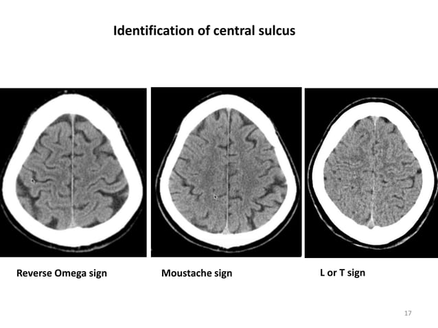 Normal anatomy of brain on CT and MRI | PPTX | Pregnancy | Reproductive ...