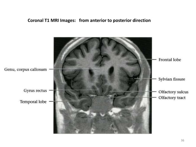 Normal anatomy of brain on CT and MRI | PPTX | Pregnancy | Reproductive ...