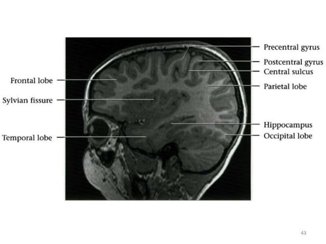 Normal anatomy of brain on CT and MRI | PPTX | Pregnancy | Reproductive ...