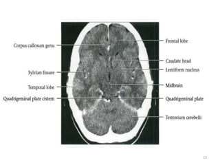 Midbrain Ct