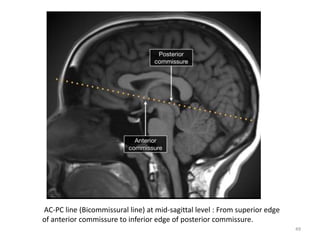 Anterior Commissure Mri