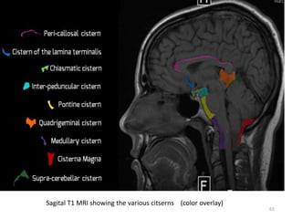 Lamina Terminalis Mri