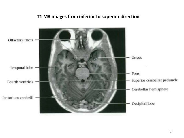 Ct Anatomy Of Brain Ppt