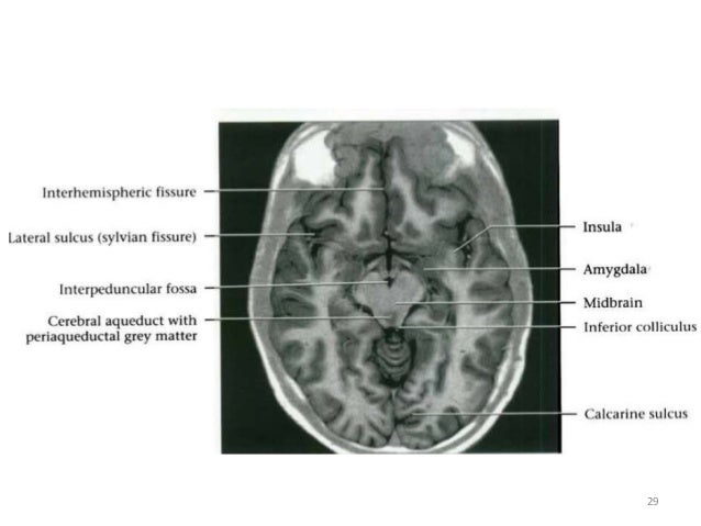 Ct Brain Normal Anatomy