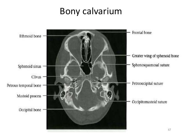 Normal anatomy of brain on CT and MRI