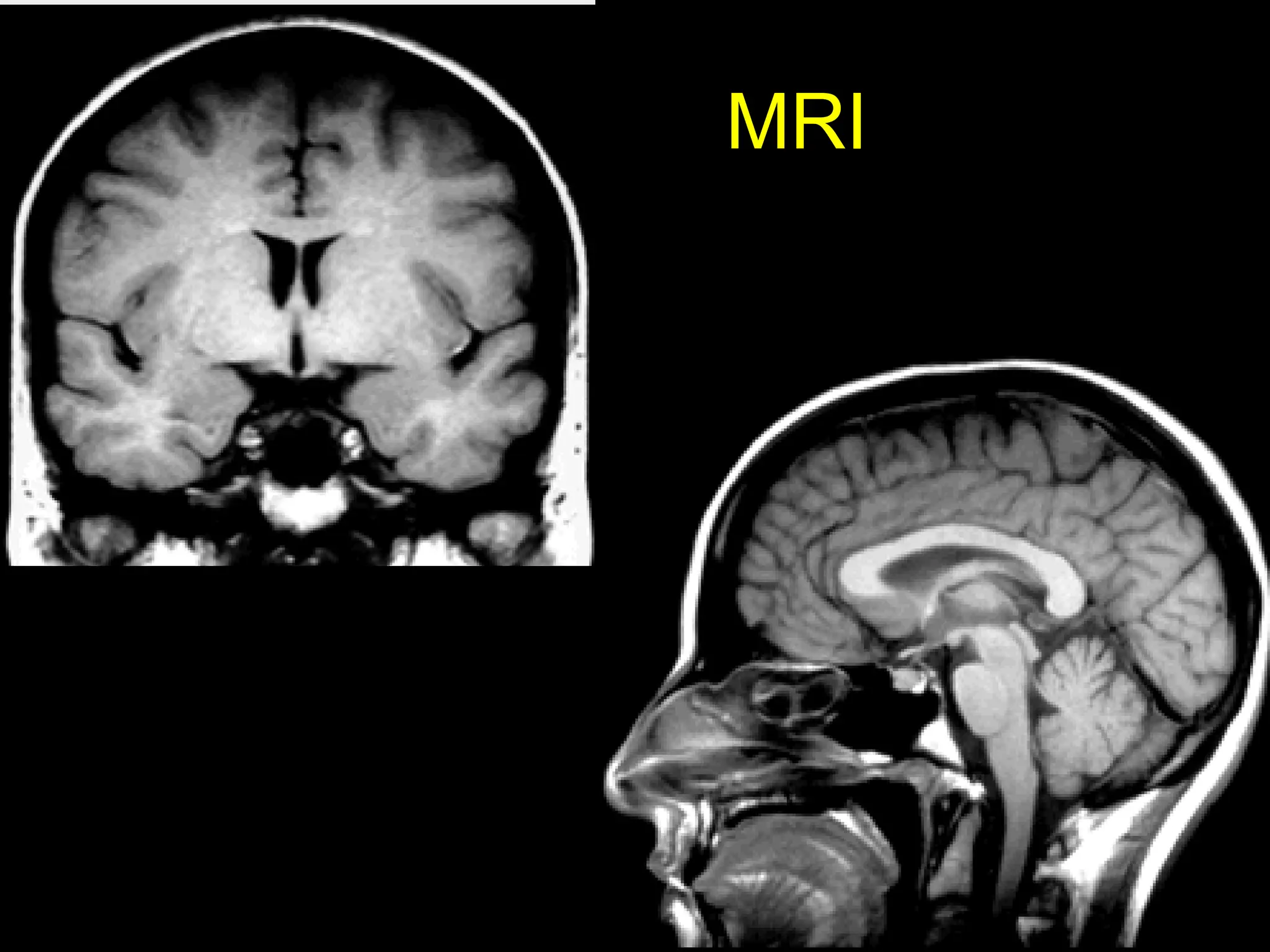 NORMAL ANATOMY OF THE HUMAN BRAIN ON CT SCAN | PPT
