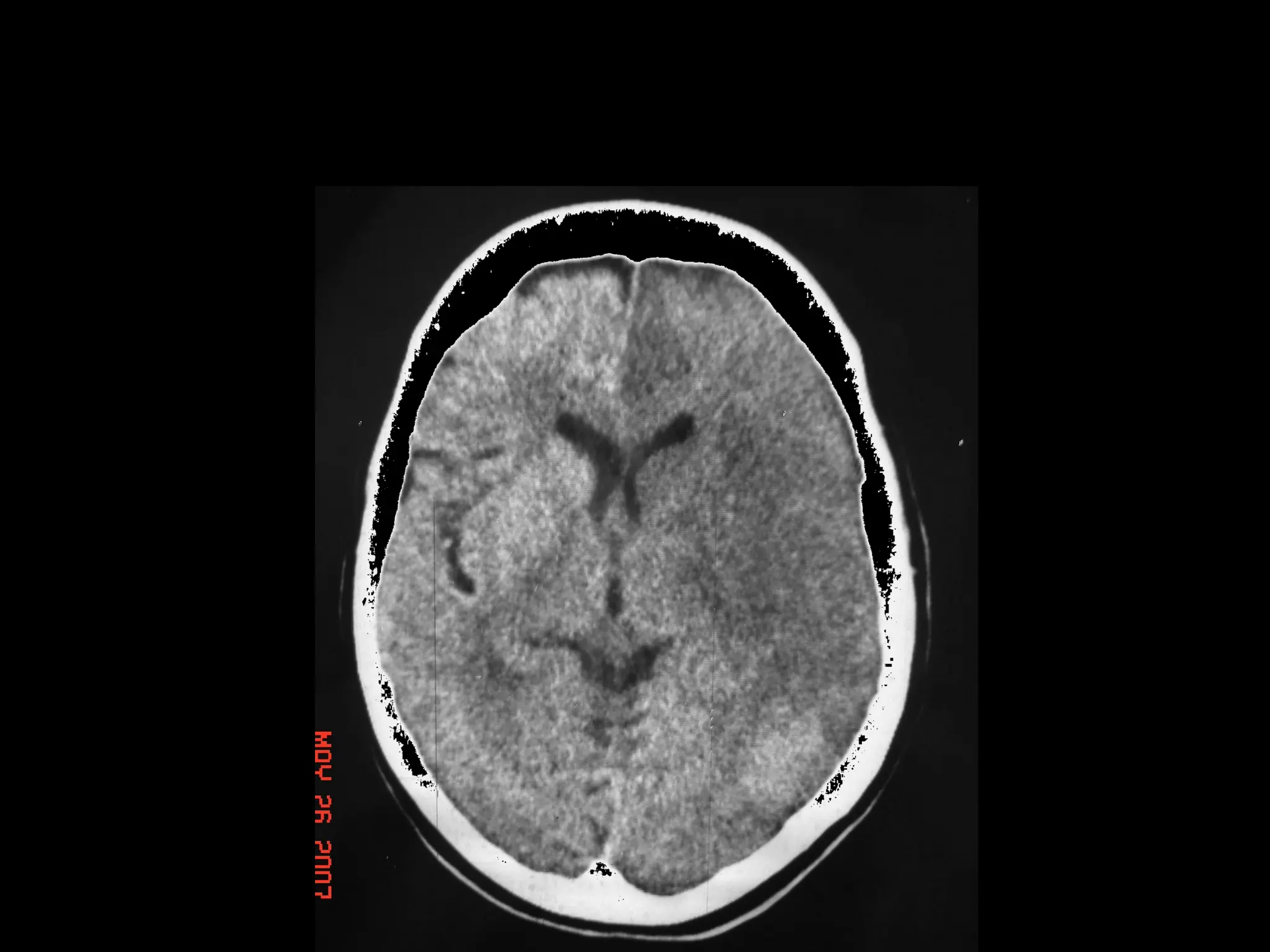 NORMAL ANATOMY OF THE HUMAN BRAIN ON CT SCAN | PPT