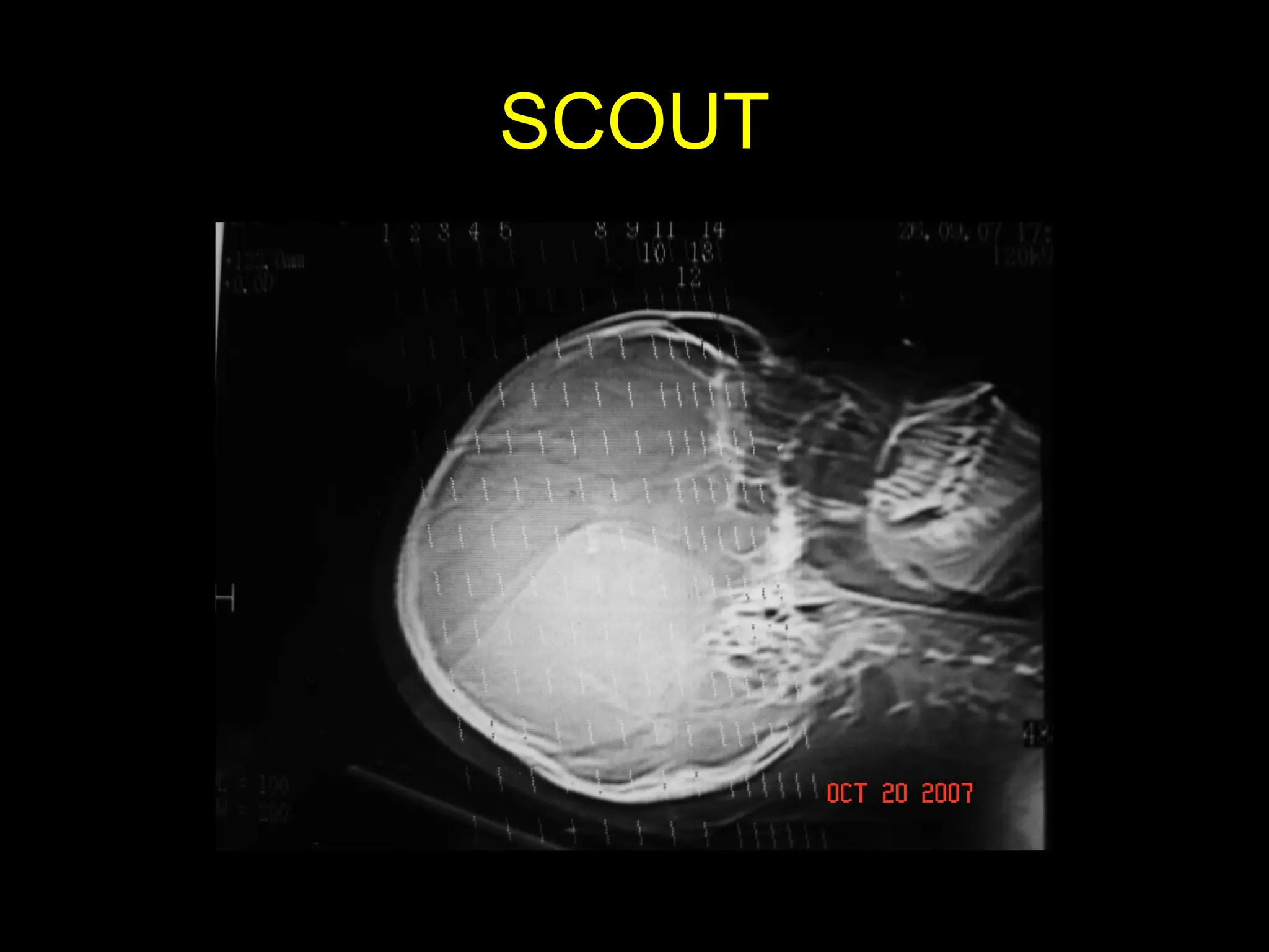 NORMAL ANATOMY OF THE HUMAN BRAIN ON CT SCAN | PPT