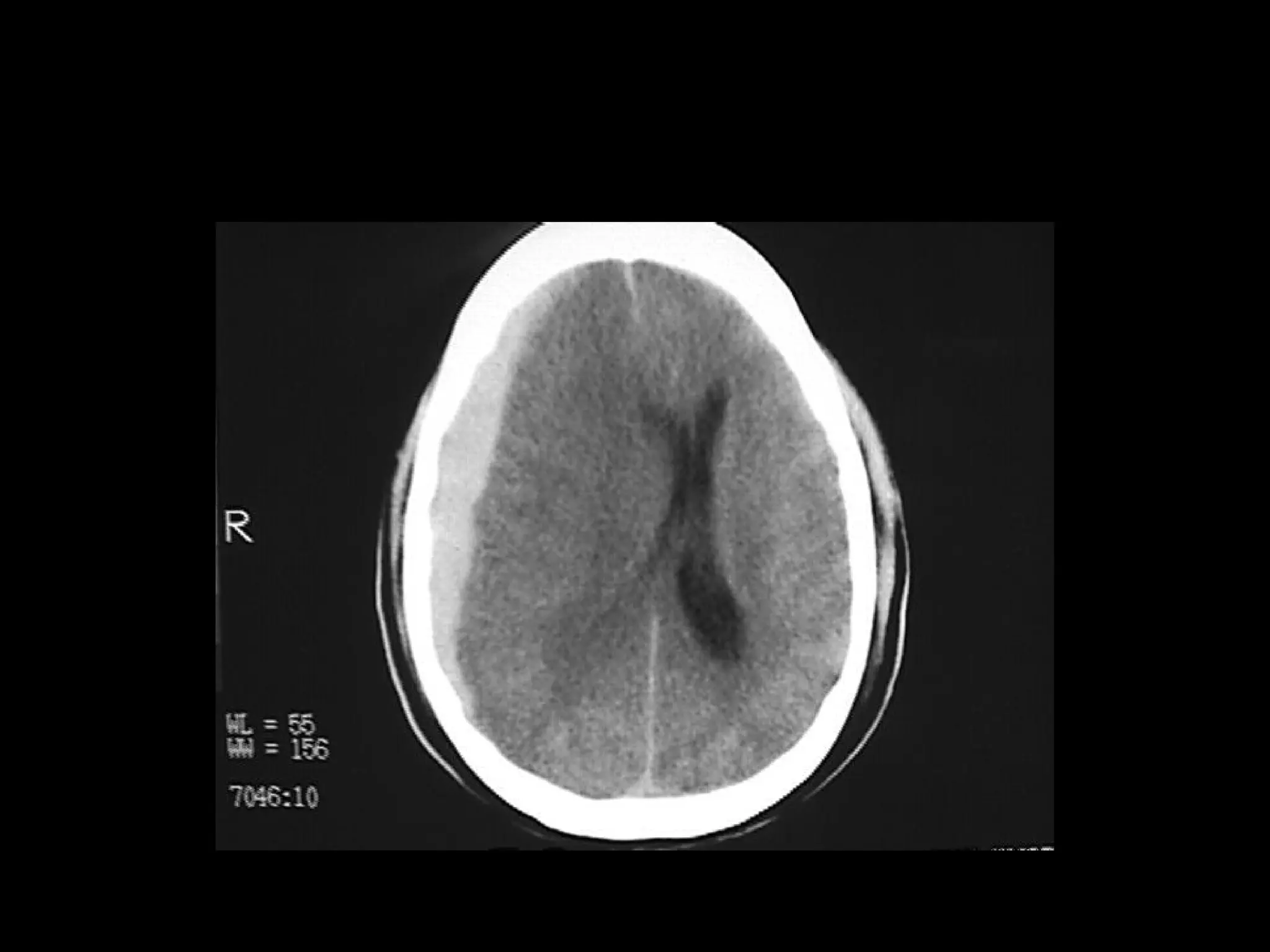NORMAL ANATOMY OF THE HUMAN BRAIN ON CT SCAN | PPT