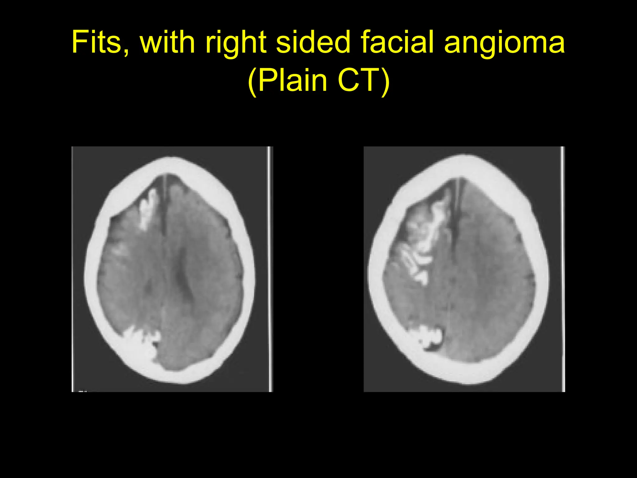 NORMAL ANATOMY OF THE HUMAN BRAIN ON CT SCAN | PPT