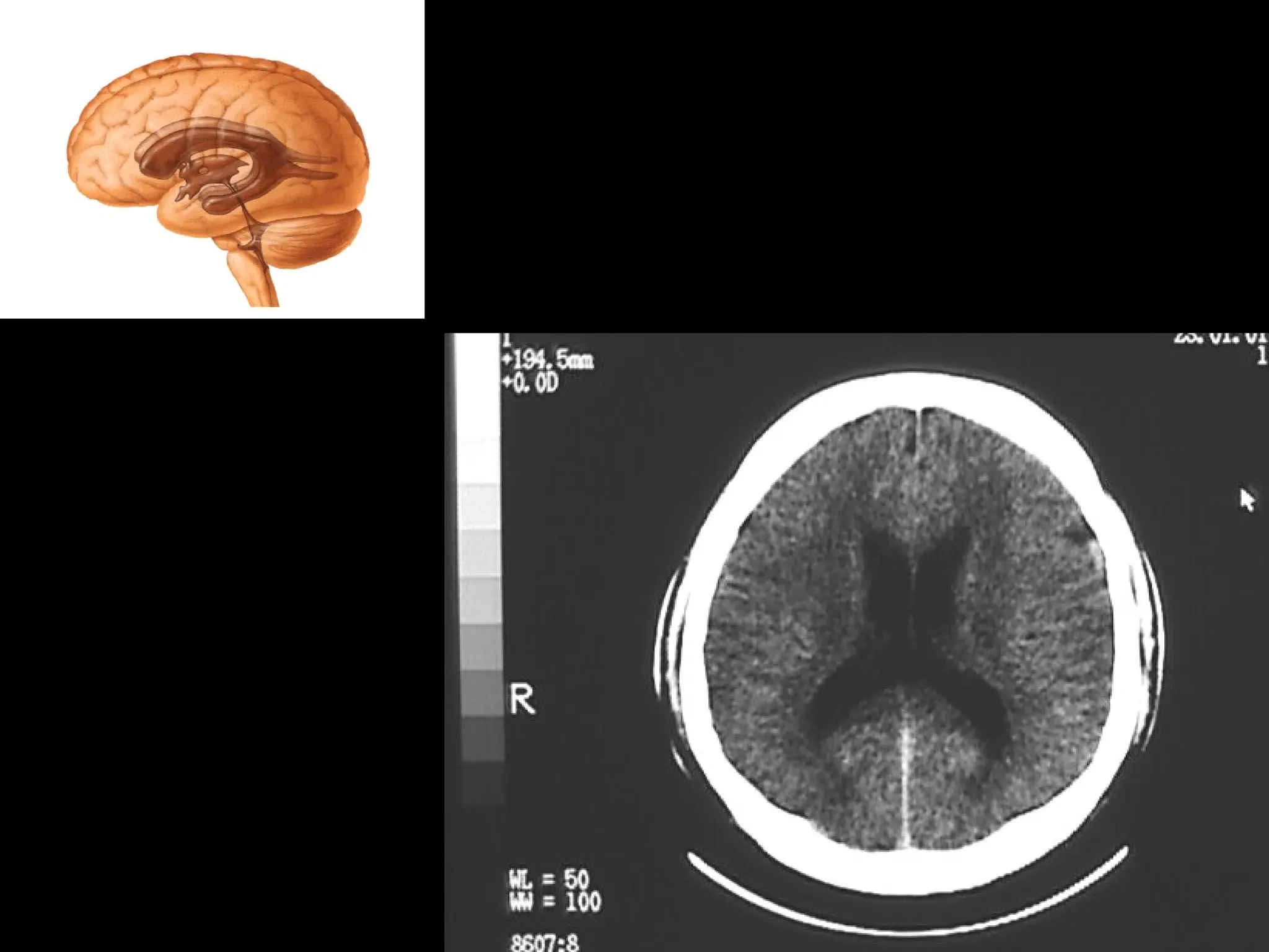 NORMAL ANATOMY OF THE HUMAN BRAIN ON CT SCAN | PPT