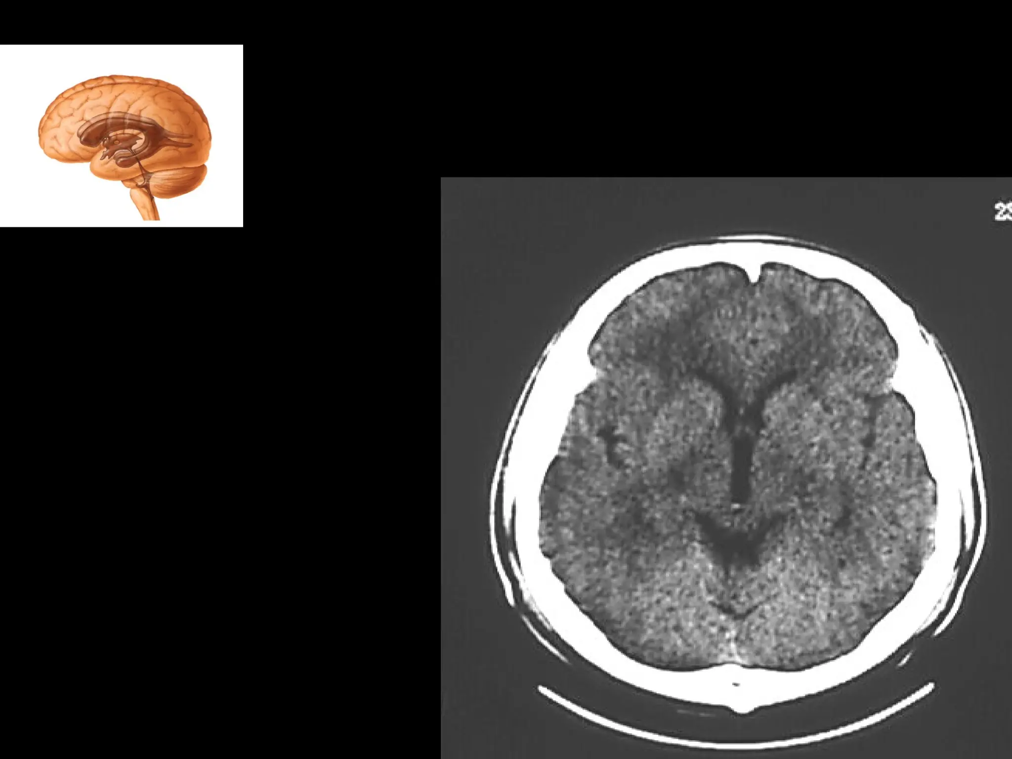 NORMAL ANATOMY OF THE HUMAN BRAIN ON CT SCAN | PPT