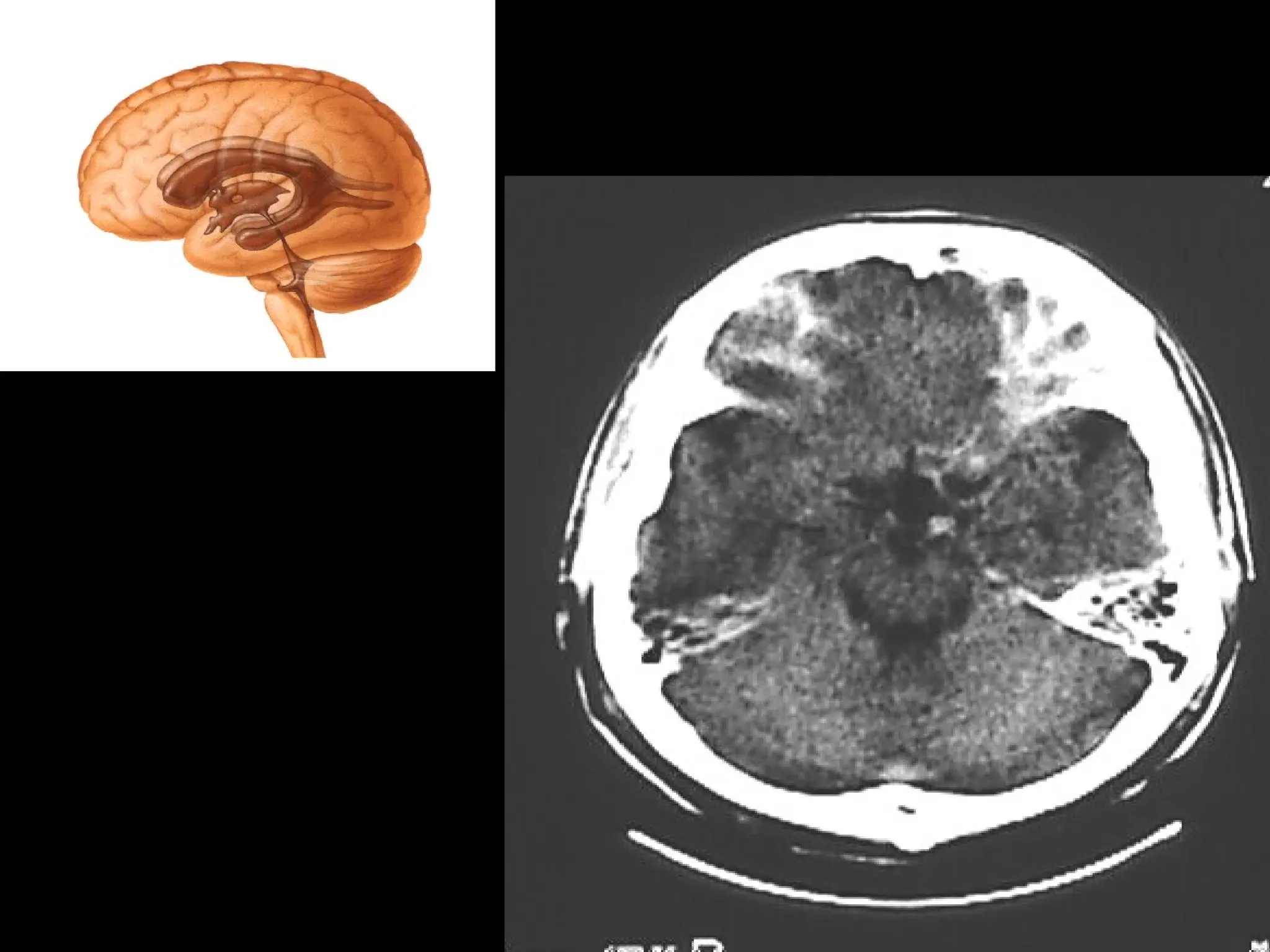 NORMAL ANATOMY OF THE HUMAN BRAIN ON CT SCAN | PPT