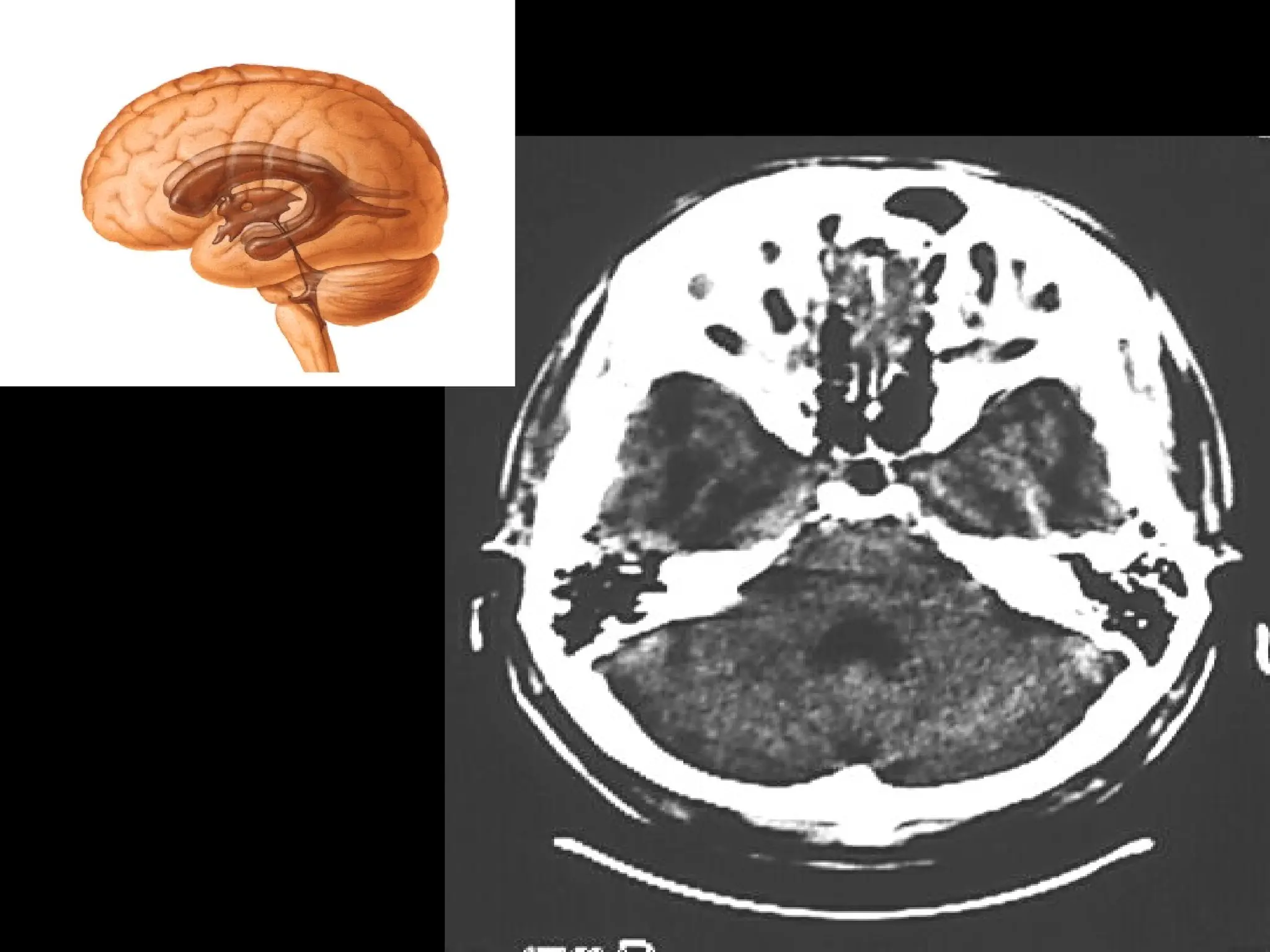 NORMAL ANATOMY OF THE HUMAN BRAIN ON CT SCAN | PPT
