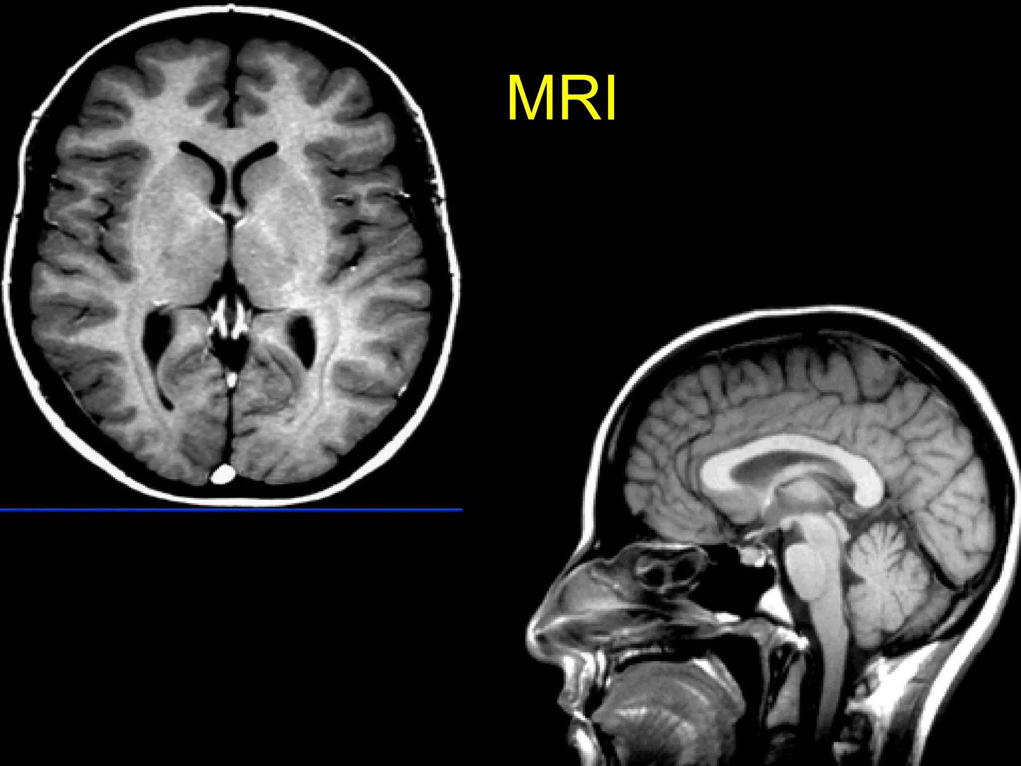 NORMAL ANATOMY OF THE HUMAN BRAIN ON CT SCAN | PPT