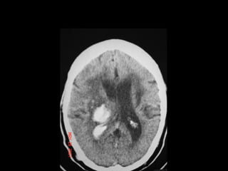NORMAL ANATOMY OF THE HUMAN BRAIN ON CT SCAN | PPT