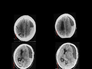 NORMAL ANATOMY OF THE HUMAN BRAIN ON CT SCAN | PPT