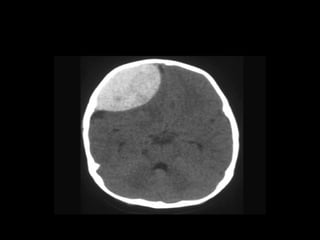 NORMAL ANATOMY OF THE HUMAN BRAIN ON CT SCAN | PPT