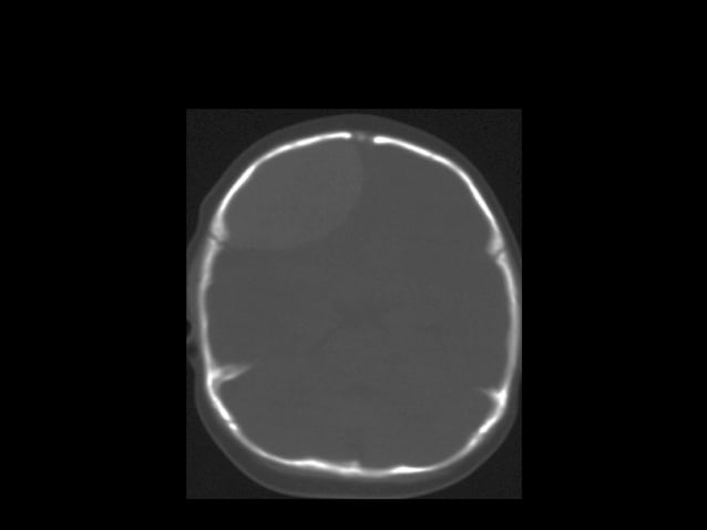 NORMAL ANATOMY OF THE HUMAN BRAIN ON CT SCAN | PPT