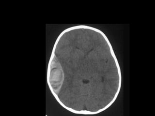NORMAL ANATOMY OF THE HUMAN BRAIN ON CT SCAN | PPT