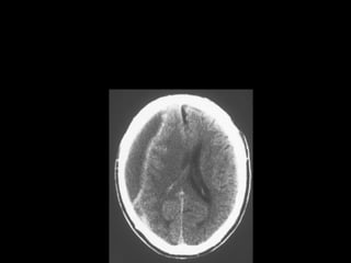 NORMAL ANATOMY OF THE HUMAN BRAIN ON CT SCAN | PPT