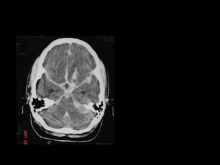NORMAL ANATOMY OF THE HUMAN BRAIN ON CT SCAN | PPT