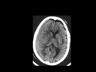NORMAL ANATOMY OF THE HUMAN BRAIN ON CT SCAN | PPT