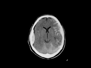 NORMAL ANATOMY OF THE HUMAN BRAIN ON CT SCAN | PPT