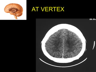 NORMAL ANATOMY OF THE HUMAN BRAIN ON CT SCAN | PPT