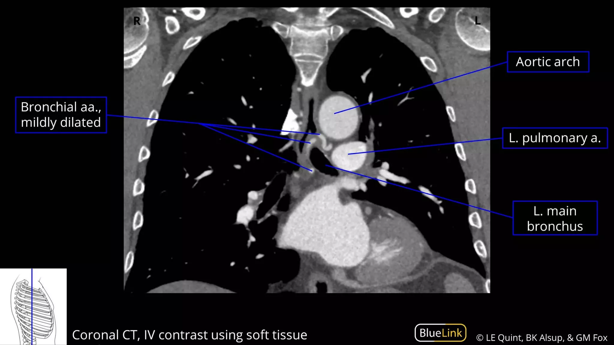 Normal Anatomy on Chest Radiograph 20-21.pdf