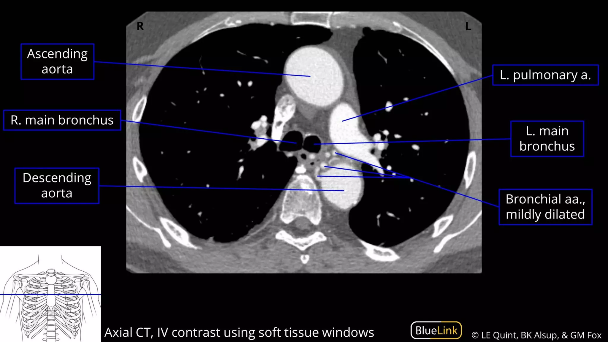 Normal Anatomy on Chest Radiograph 20-21.pdf