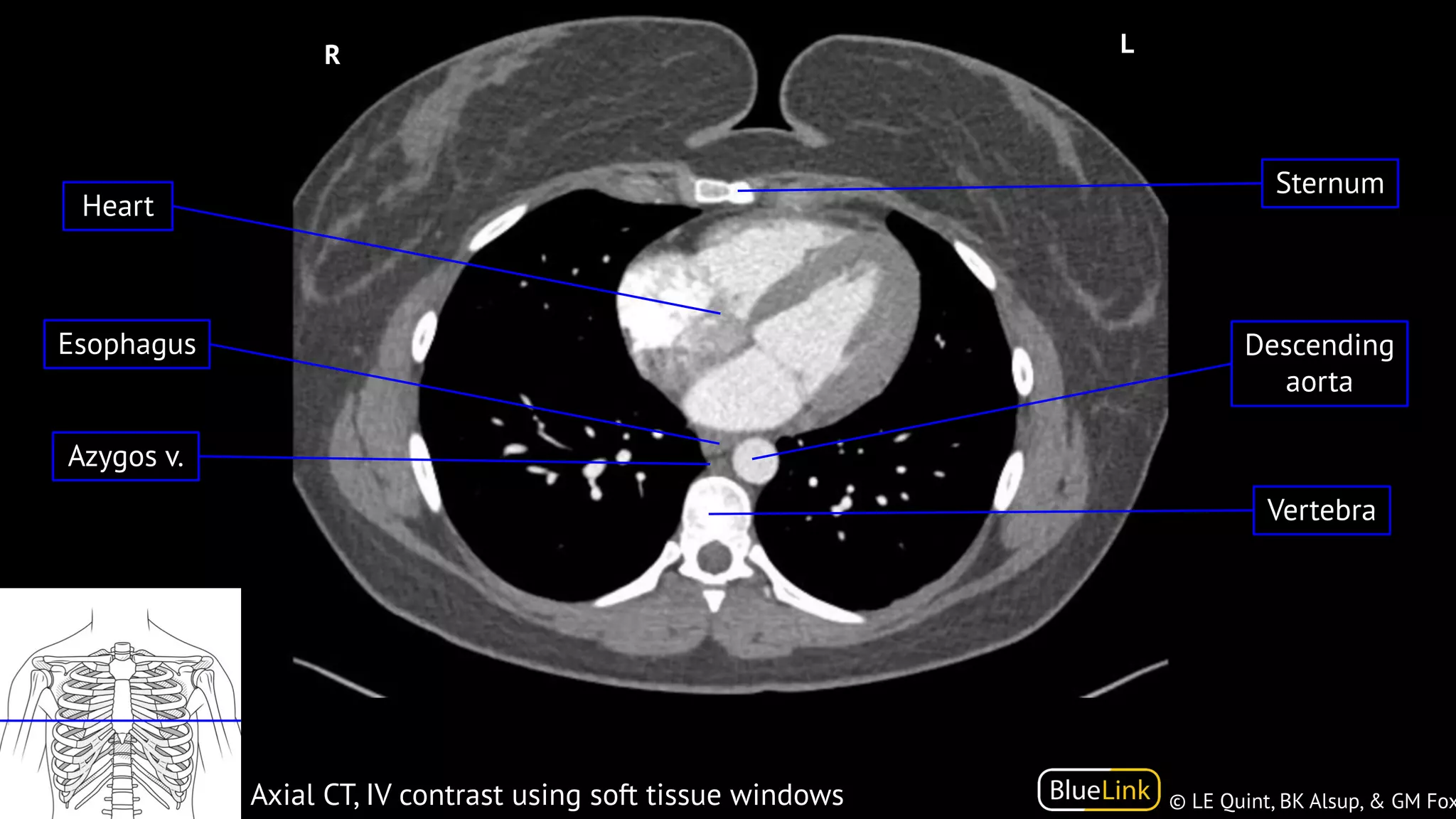 Normal Anatomy on Chest Radiograph 20-21.pdf