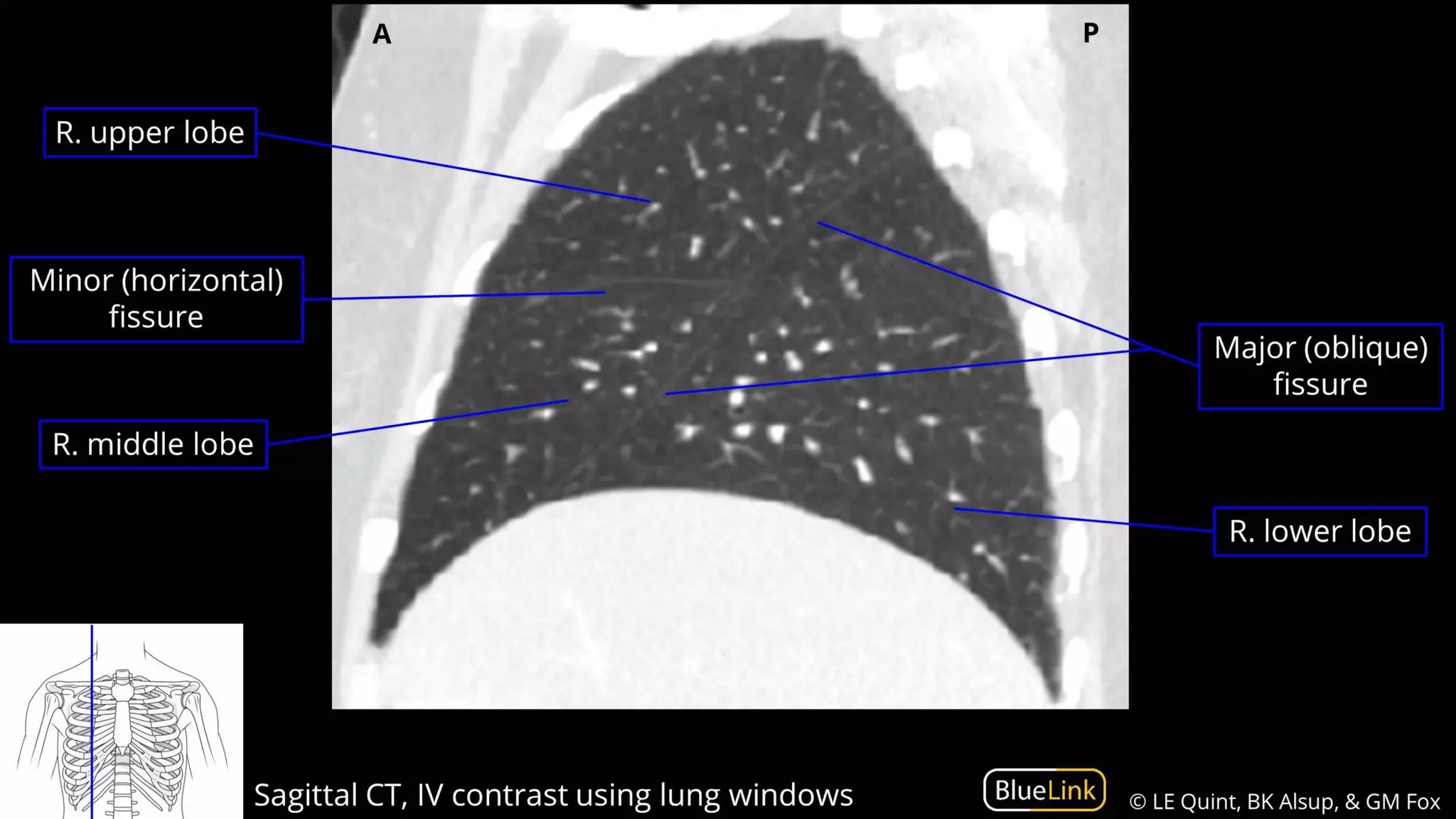 Normal Anatomy on Chest Radiograph 20-21.pdf
