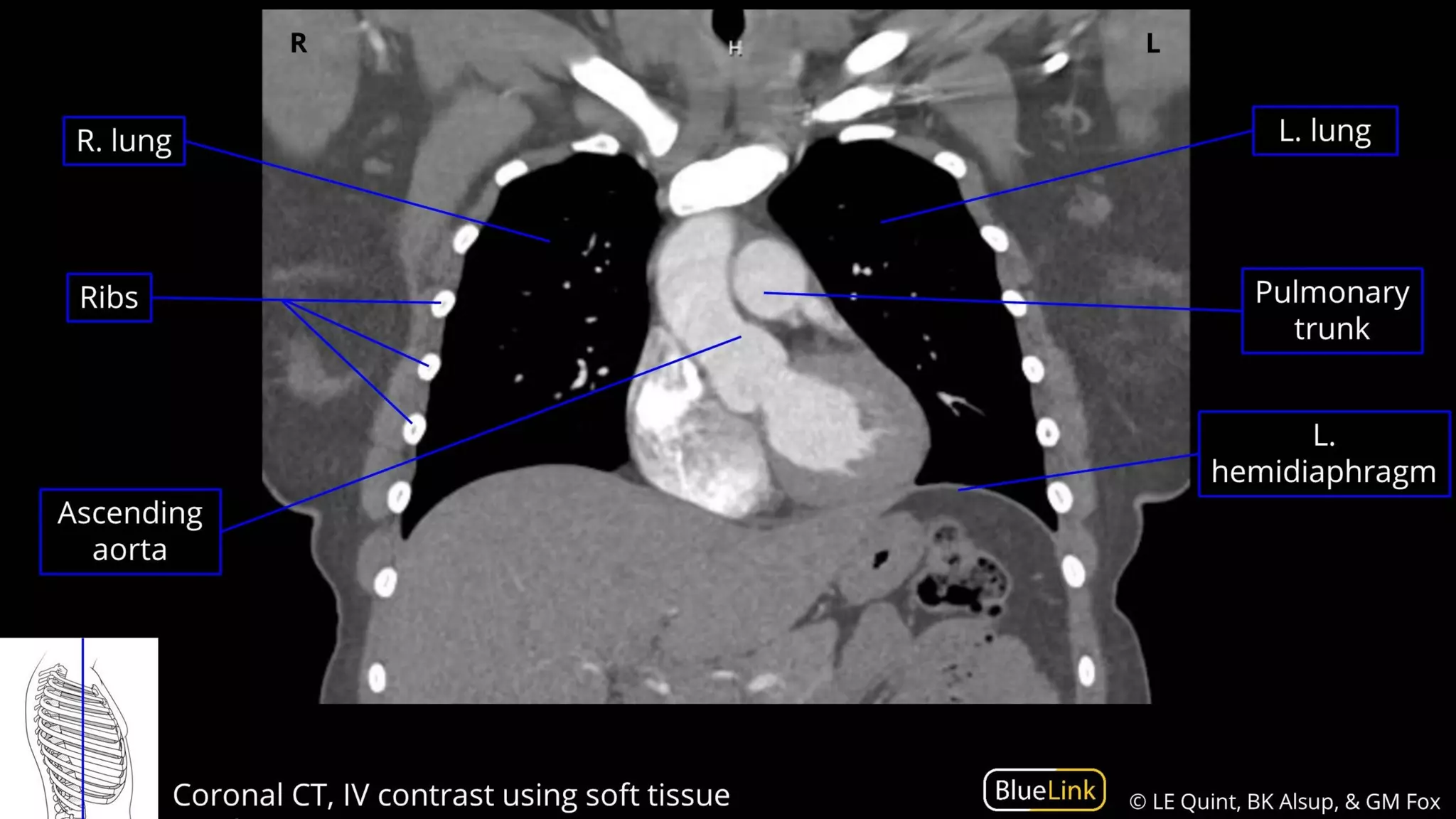 Normal Anatomy on Chest Radiograph 20-21.pdf