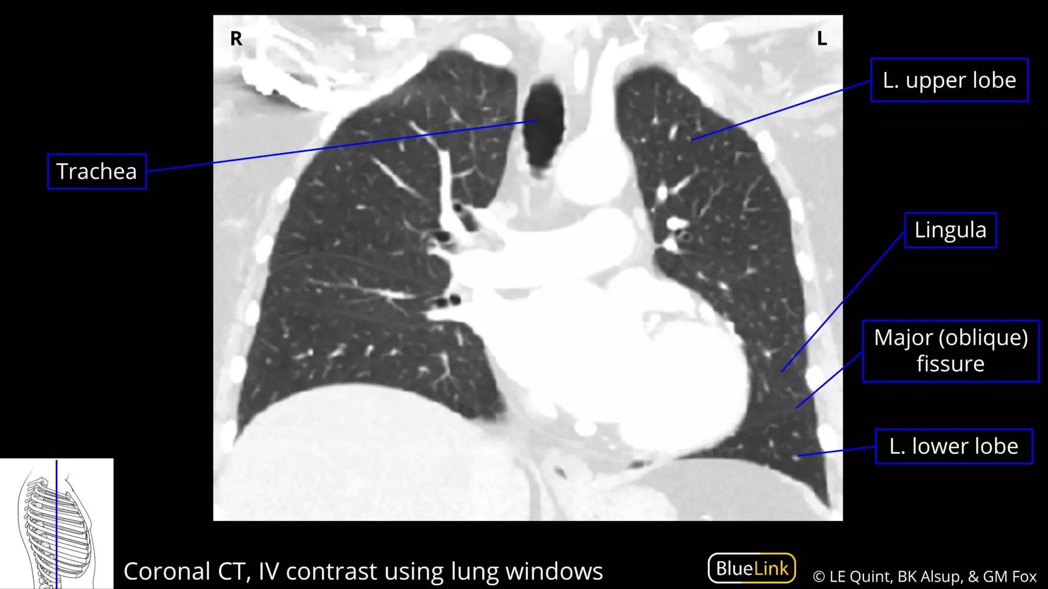 Normal Anatomy on Chest Radiograph 20-21.pdf