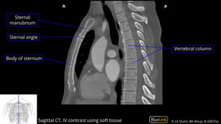 Normal Anatomy on Chest Radiograph 20-21.pdf