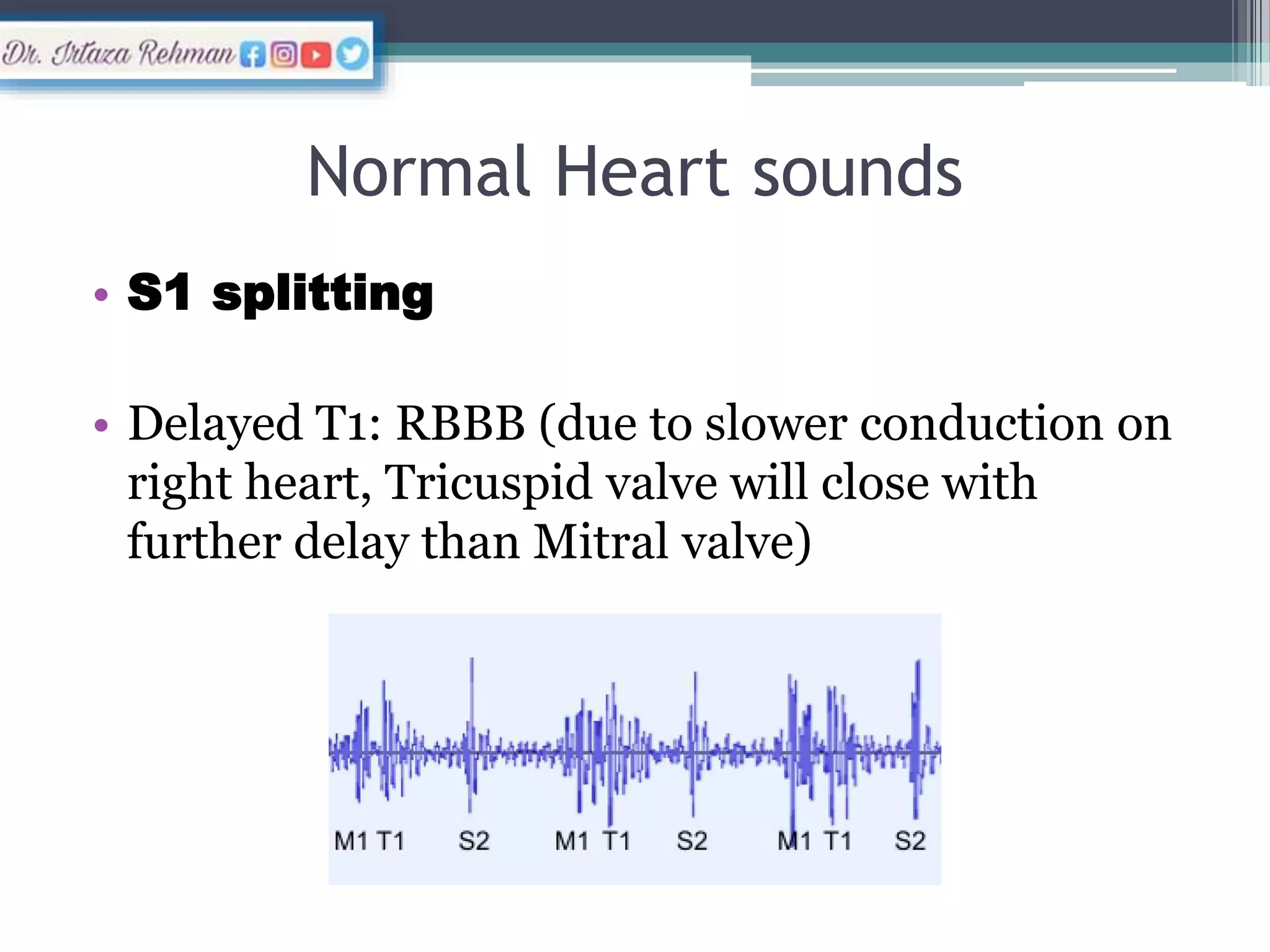 Normal and abnormal Heart sounds (Murmurs).pptx